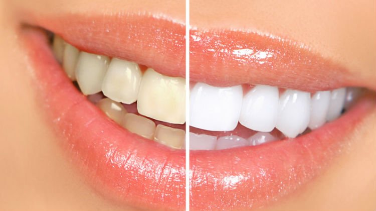 dientes1 - HeyHeyHello!